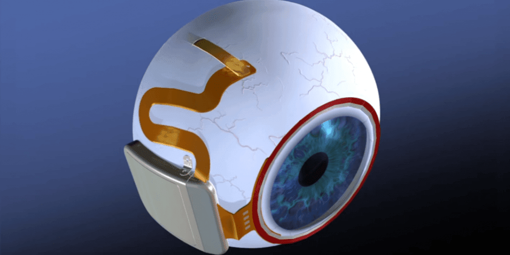 Artificial retina implant created for the first time to restore vision