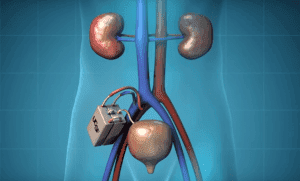 Artificial kidney designed by US scientists that could replace dialysis