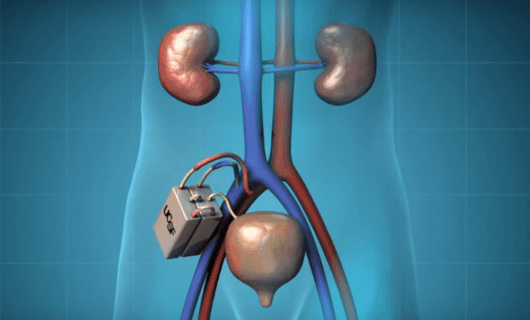 Artificial kidney designed by US scientists that could replace dialysis